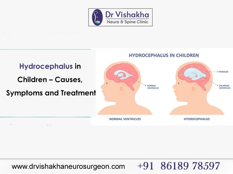 Hydrocephalus in Children – Causes, Symptoms and Treatment - Dr Vishaka ...